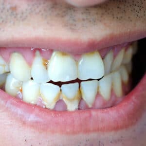 Reverse Tooth Decay & Prevent Cavities – Expert Tips